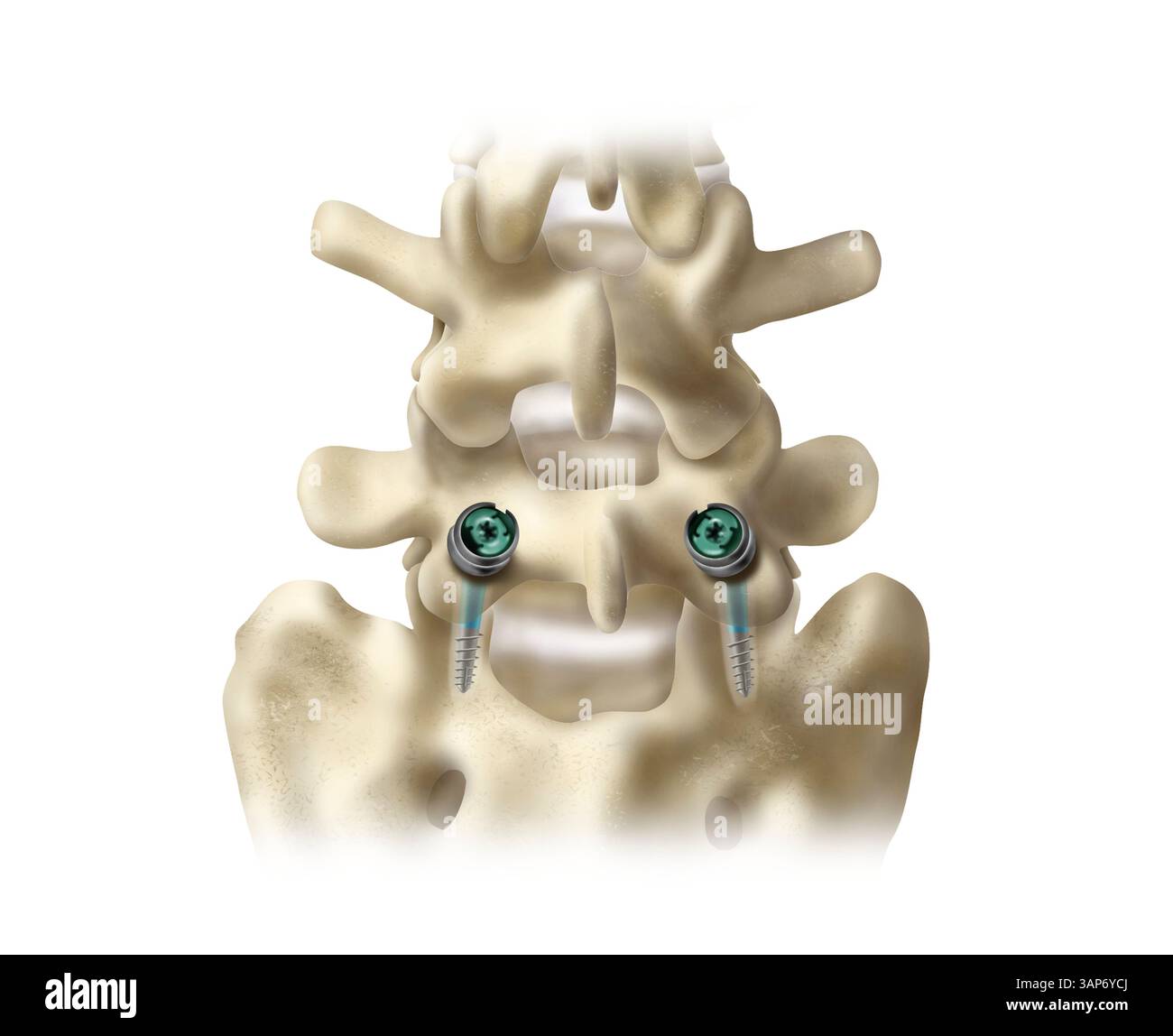 Illustration of the posterior lumbar (lower back) vertebrae showing the ...