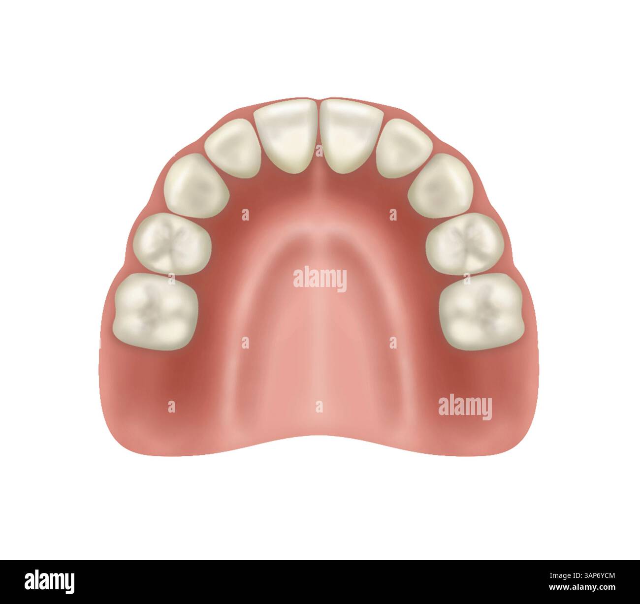 Illustration of a mildly resorbed edentulous maxillary (upper jaw) arch ...