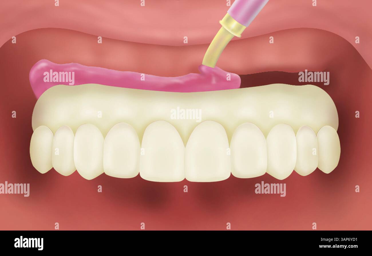 Illustration of a wax try-in prosthesis fitted inside the mouth ...