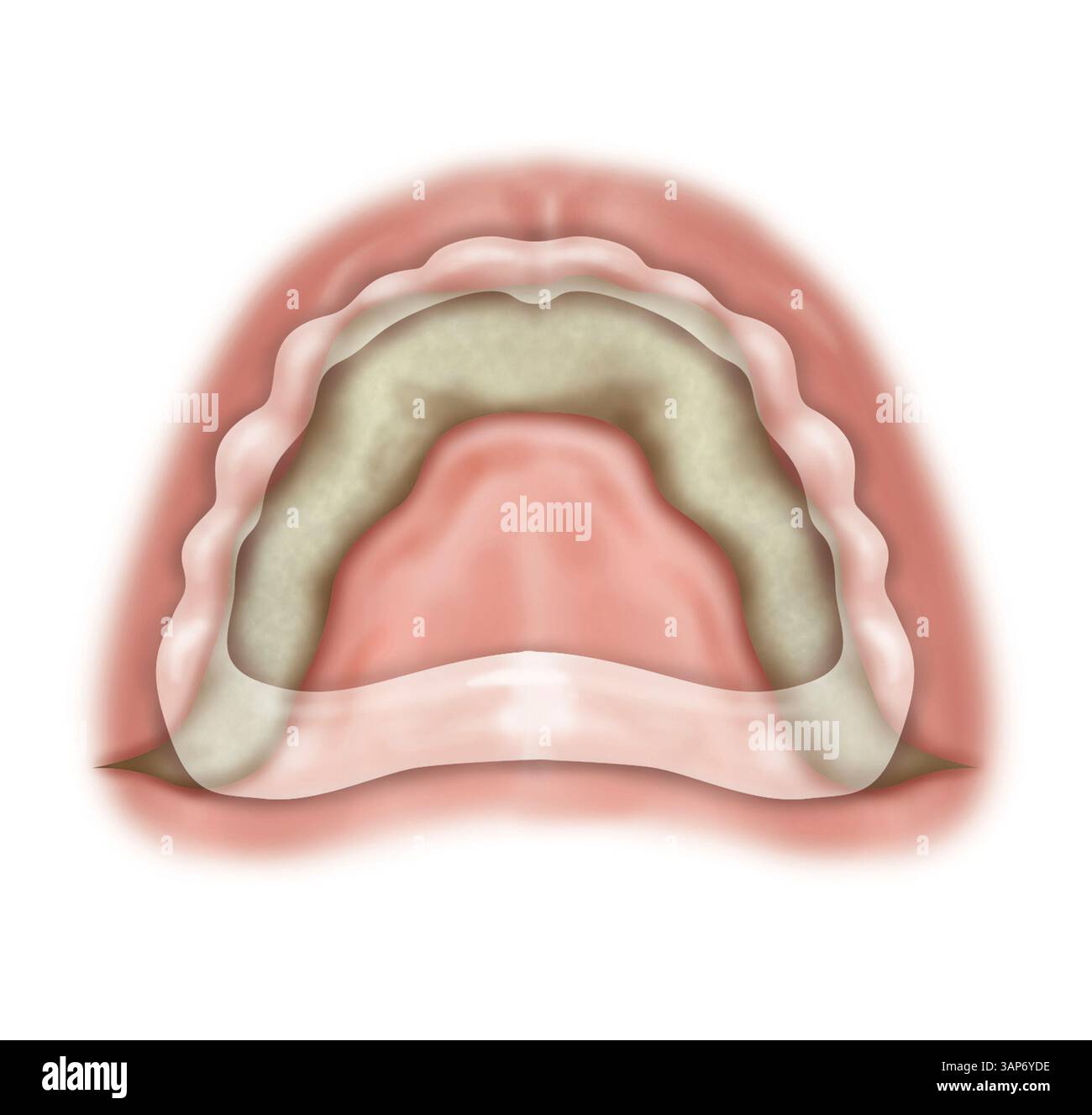 Illustration of an edentulous jaw fitted with a surgical stent, guiding ...