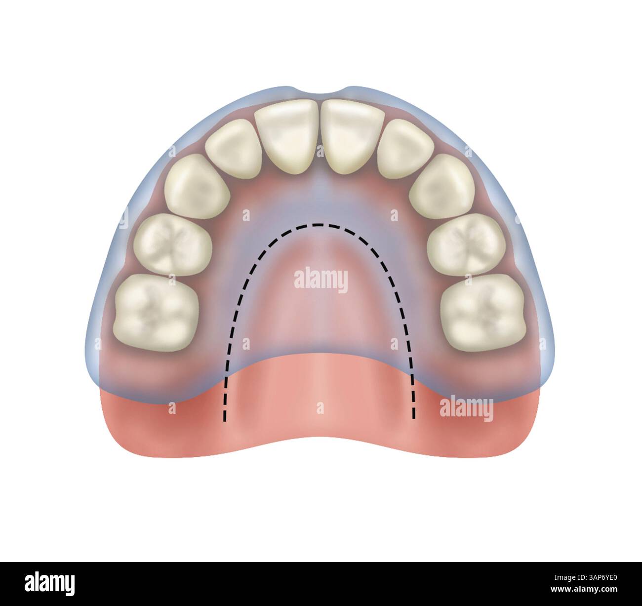 Illustration of a severely resorbed edentulous maxillary (upper jaw ...