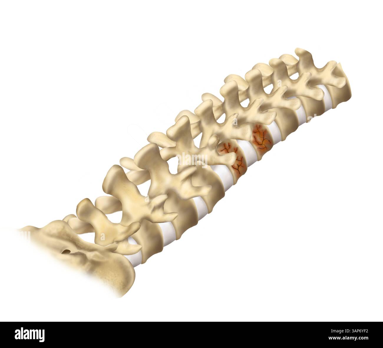 Rods and screws to stabilise injured lumbar vertebrae, illustration ...