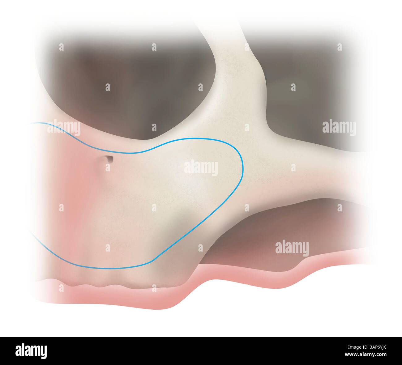 Illustration showing the zygomatic arch, a bony structure forming the ...