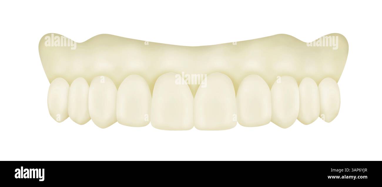 Illustration of a wax duplicate prosthesis with flanges. The duplicate ...