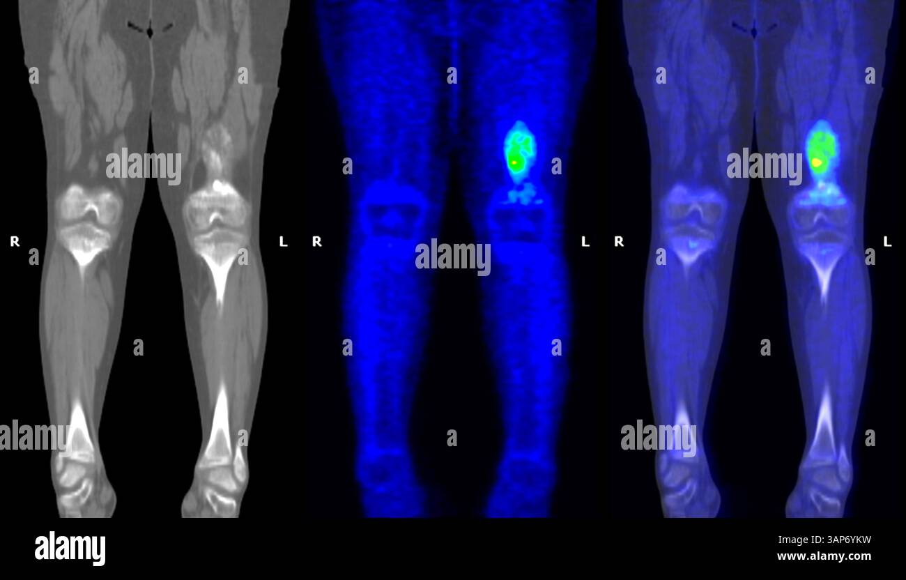 Osteosarcoma of the left femur, CT and PET scans Stock Photo - Alamy