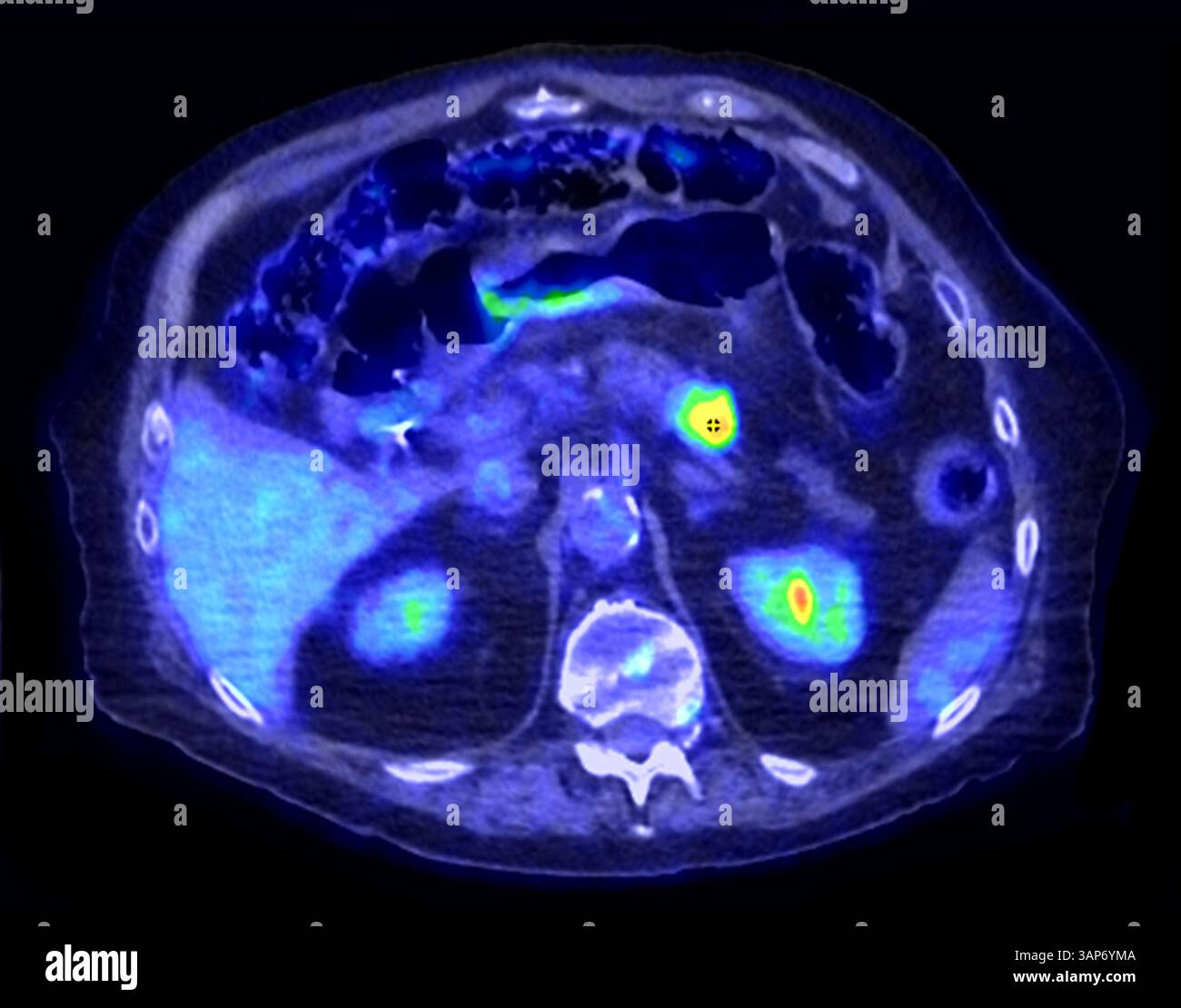 Tail pancreatic cancer, CT-PET scan Stock Photo - Alamy