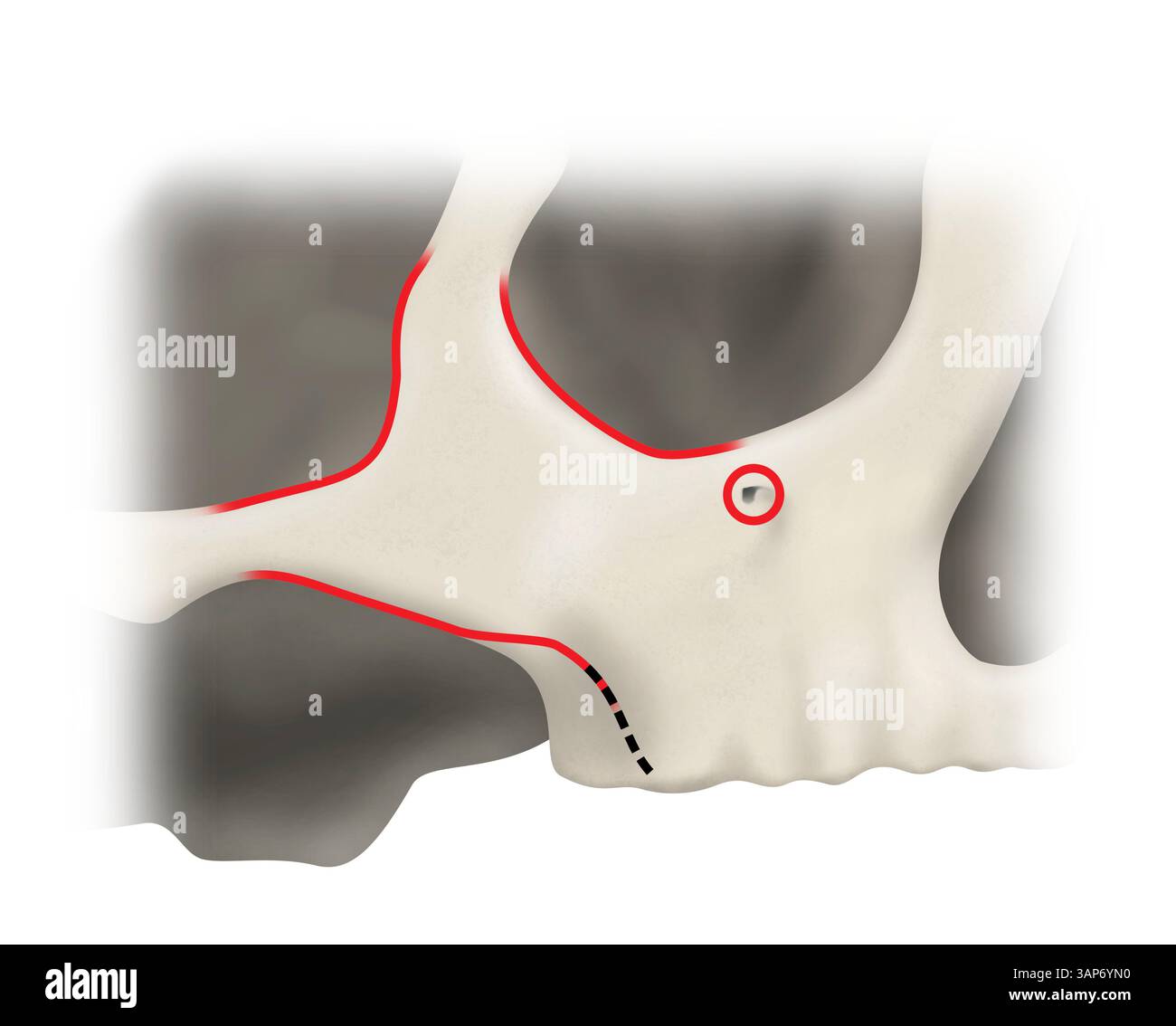 Illustration of the resorption of the zygomatic arch showing the ...