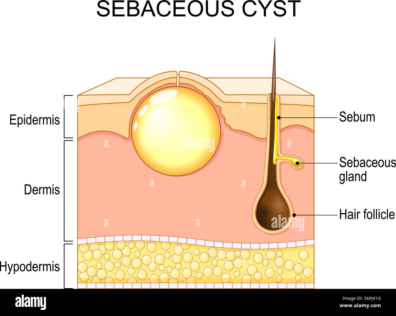 Lump that forms in the skin from a hair follicle. Wen. pilar cyst. Trichilemmal cyst. Sebaceous ...