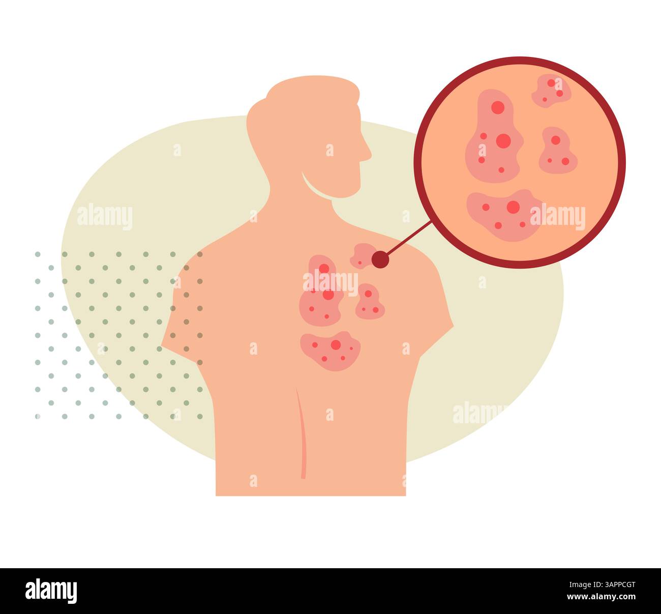 Raised Skin bumps and Patches on Back Body - Stock Illustration as EPS ...