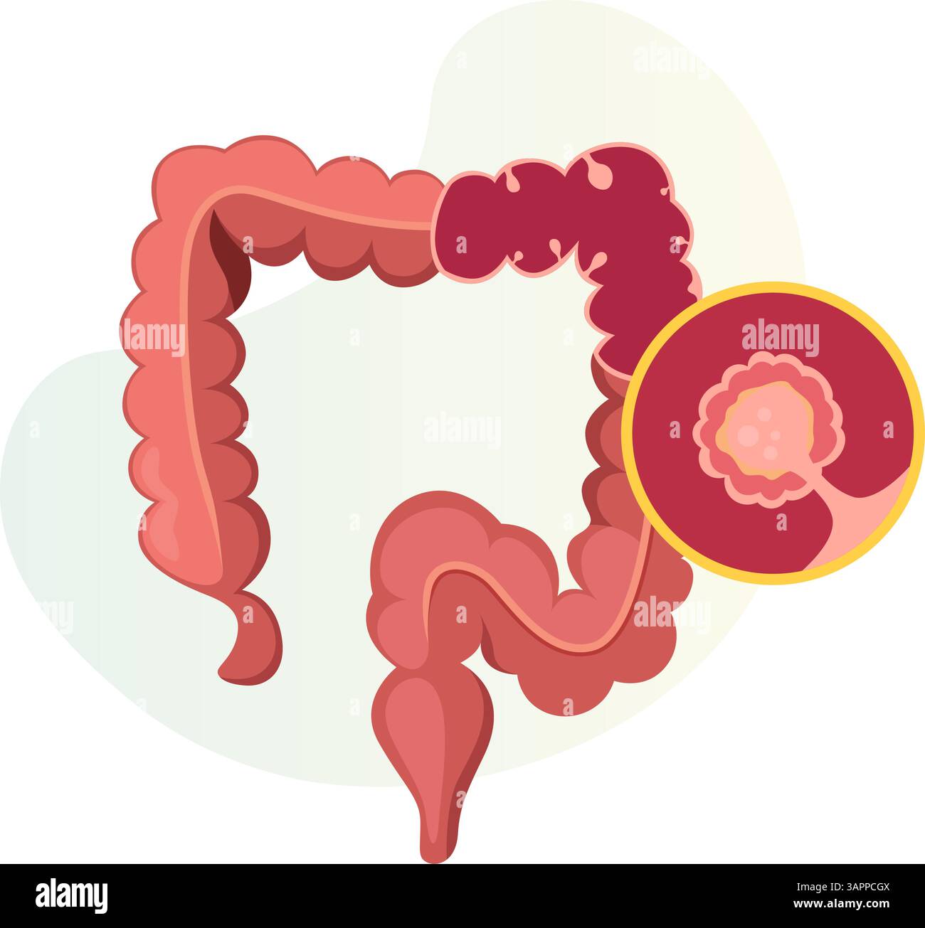 Colon Polyps - An Abnormal Tissue Growths - Stock Illustrations as EPS ...