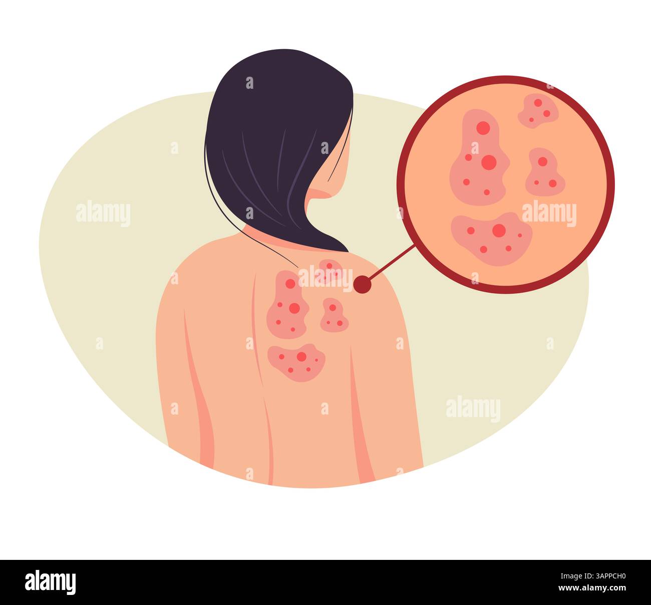 Skin symptom Cut Out Stock Images & Pictures - Alamy