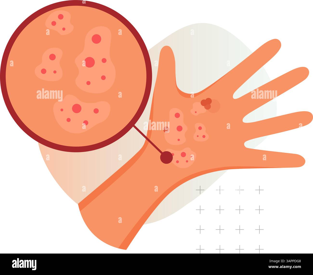Skin rashes spots symptoms Cut Out Stock Images & Pictures - Alamy