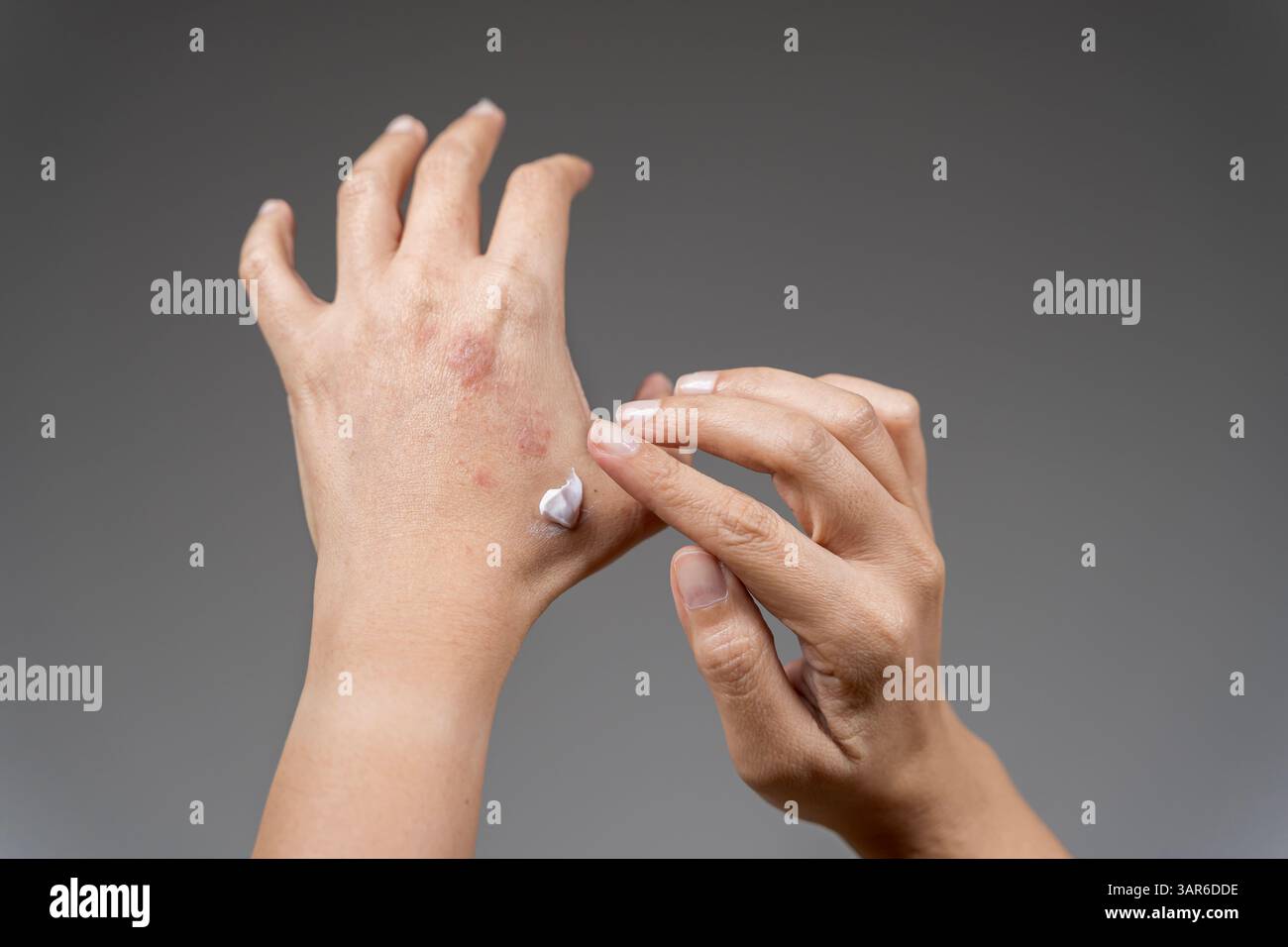 Applying cream woman's hand. Apply topical steroids, medical concept ...
