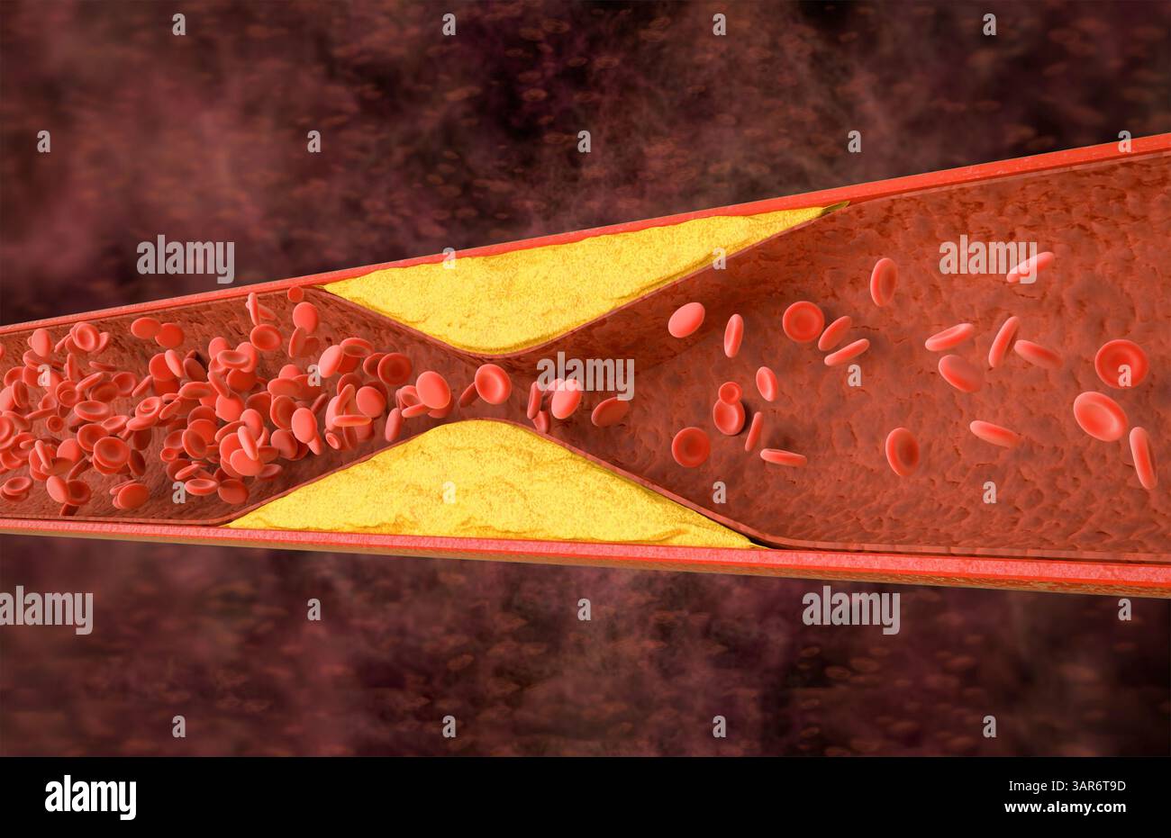 3d rendering atherosclerosis with cholesterol blood or plaque in vessel ...