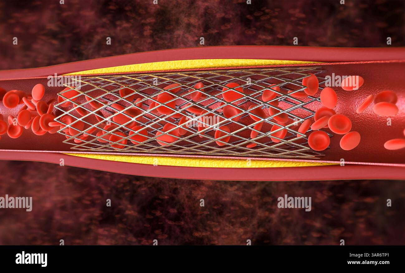 3d rendering balloon angioplasty procedure with stent in vein Stock ...
