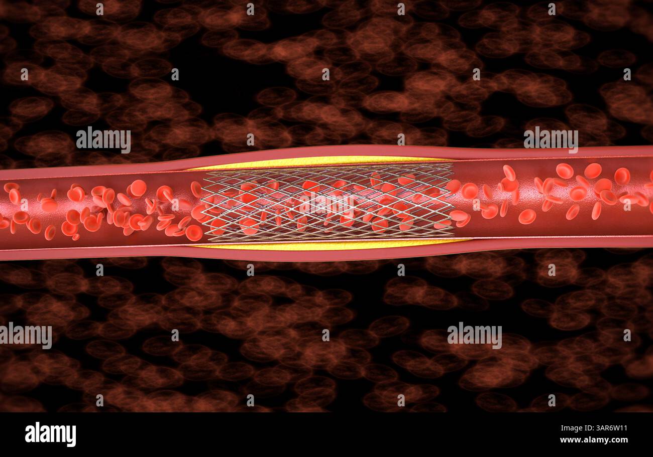 3d rendering balloon angioplasty procedure with stent in vein Stock ...