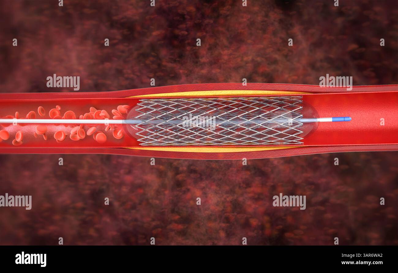 3d rendering balloon angioplasty procedure with stent in vein Stock ...