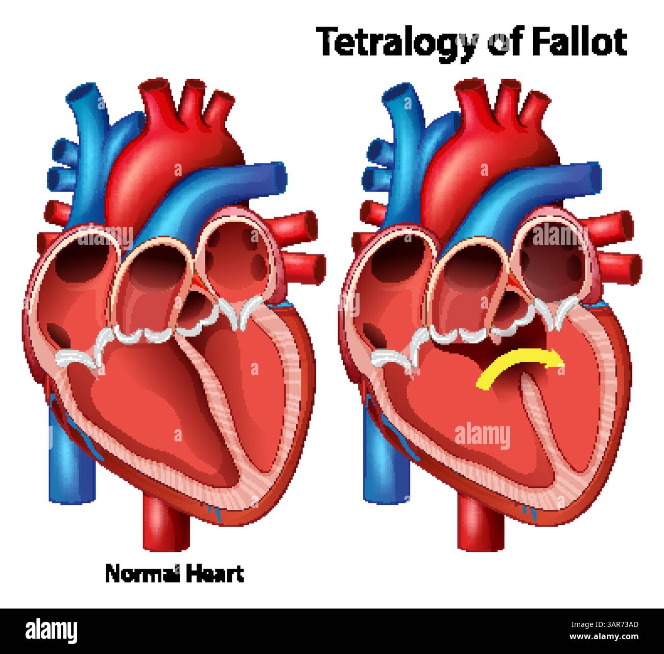 Vector illustration comparing a normal heart with Tetralogy of Fallot. Detailed anatomical ...