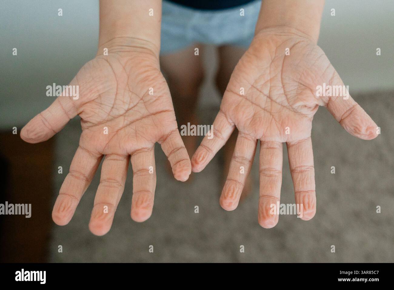 Pruney hands displayed with palms open, showcasing the effect of ...