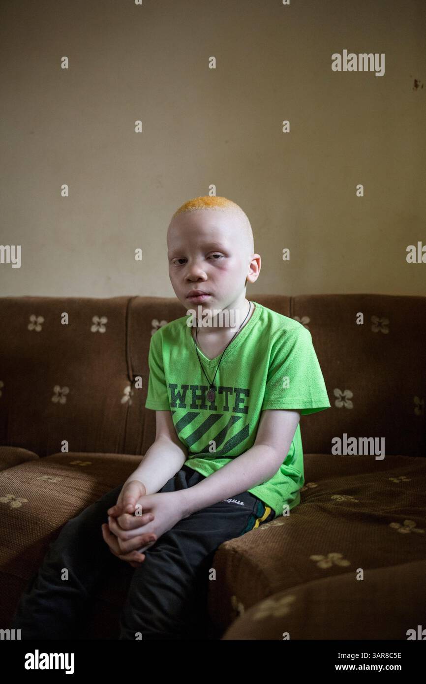People with albinism in Kampala, Uganda, Africa Stock Photo - Alamy