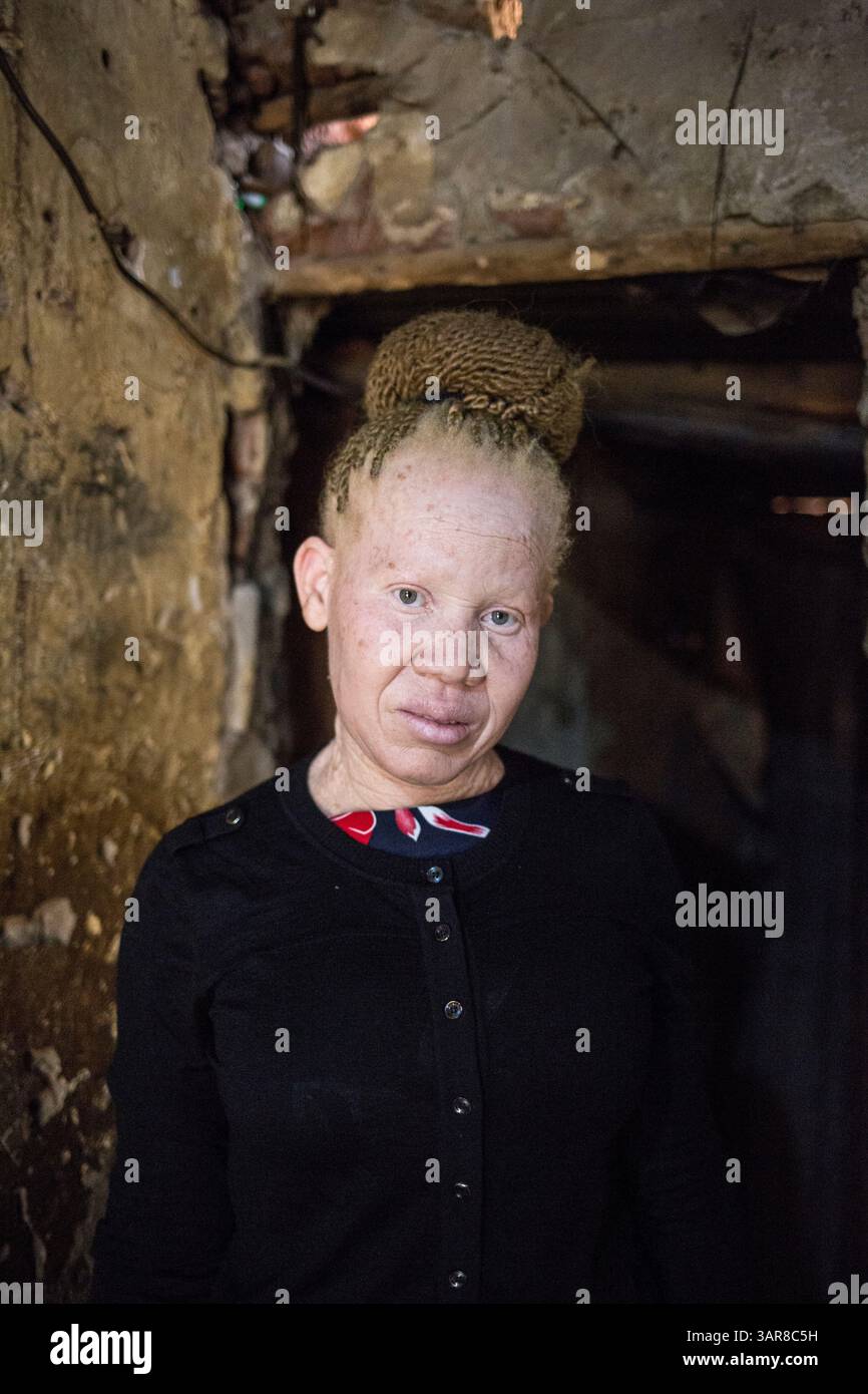 People with albinism in Kampala, Uganda, Africa Stock Photo - Alamy