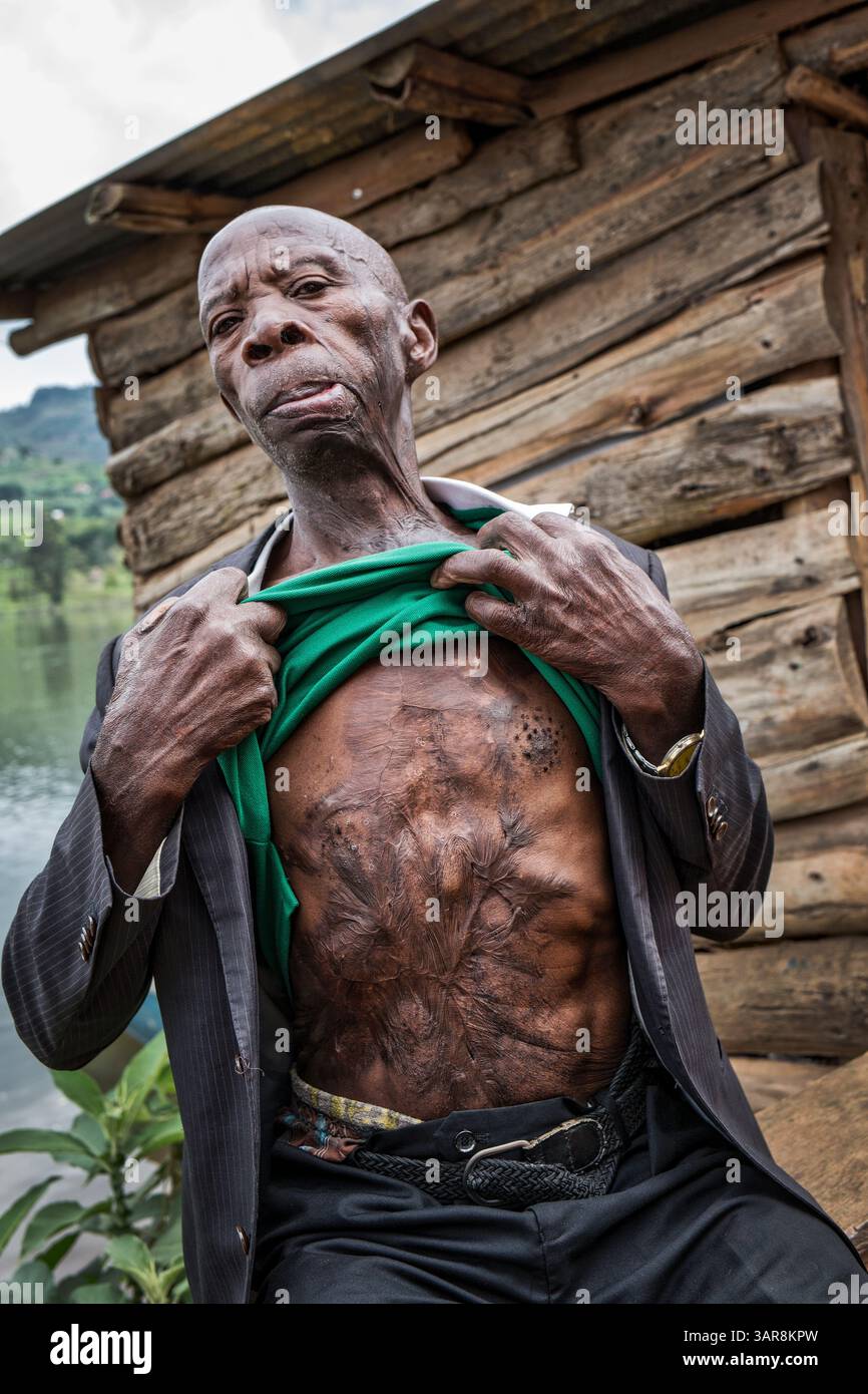 Acid attack survivors in Uganda, Africa Stock Photo - Alamy