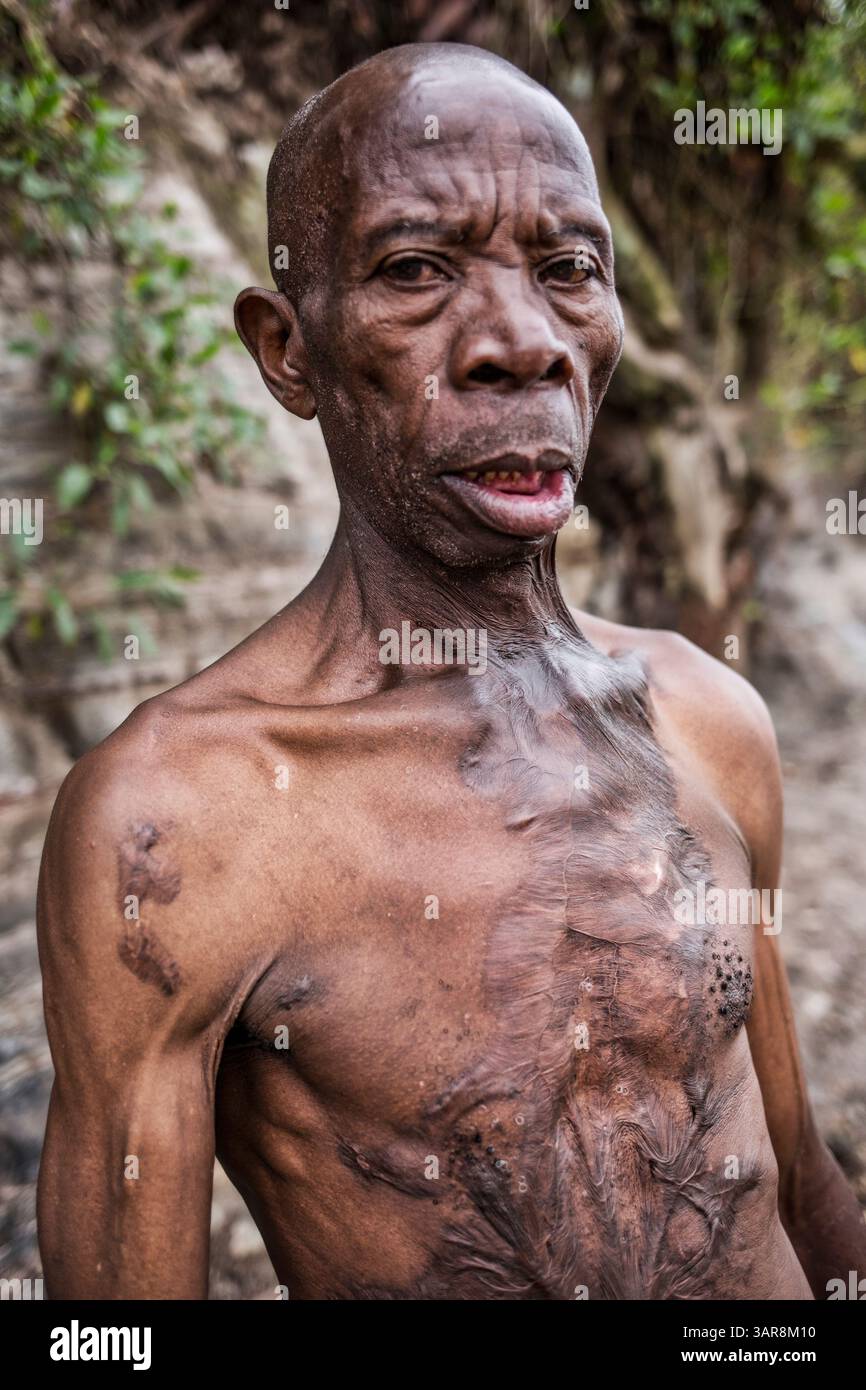 Acid attack survivors in Uganda, Africa Stock Photo - Alamy