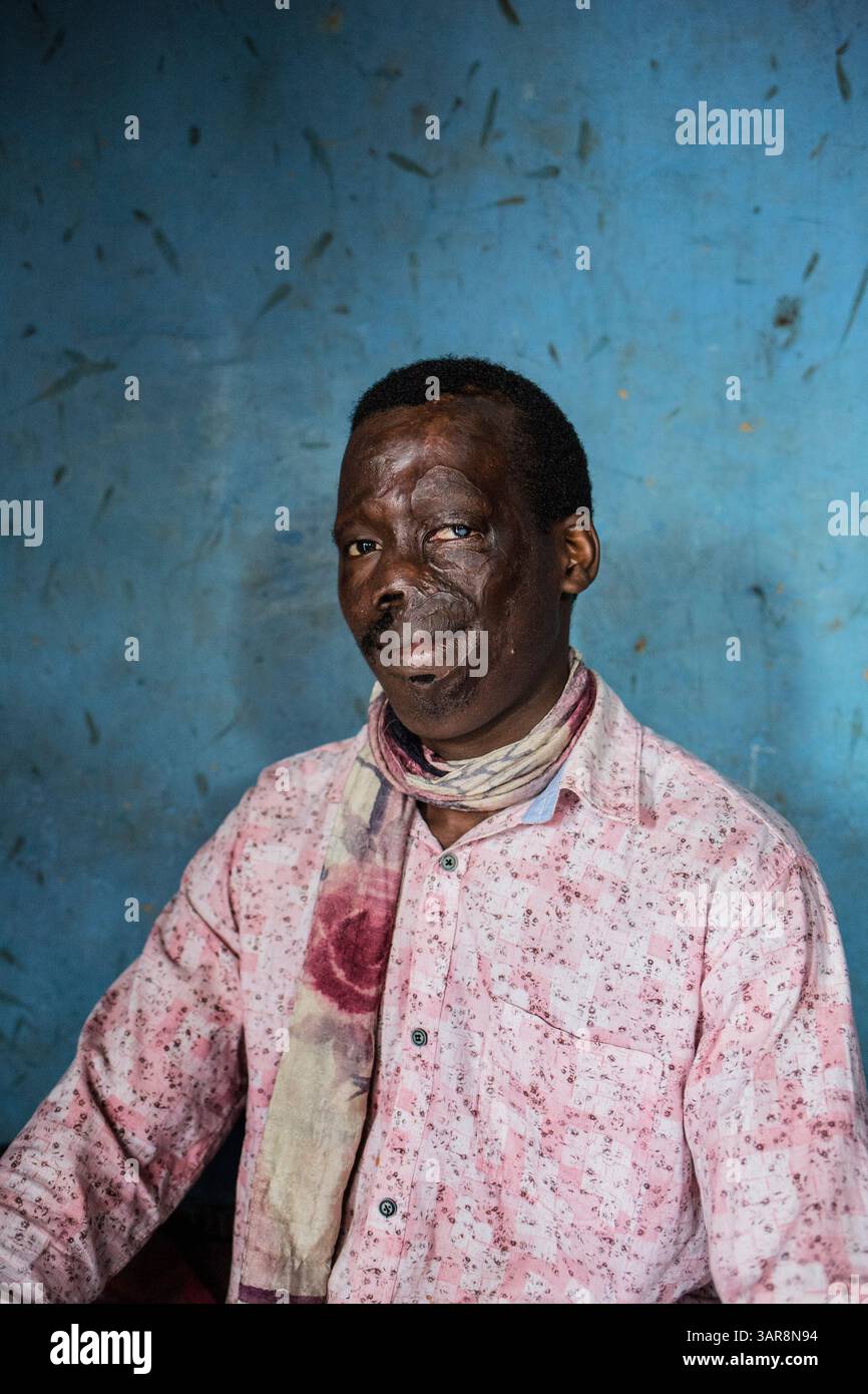 Acid attack survivors in Uganda, Africa Stock Photo - Alamy