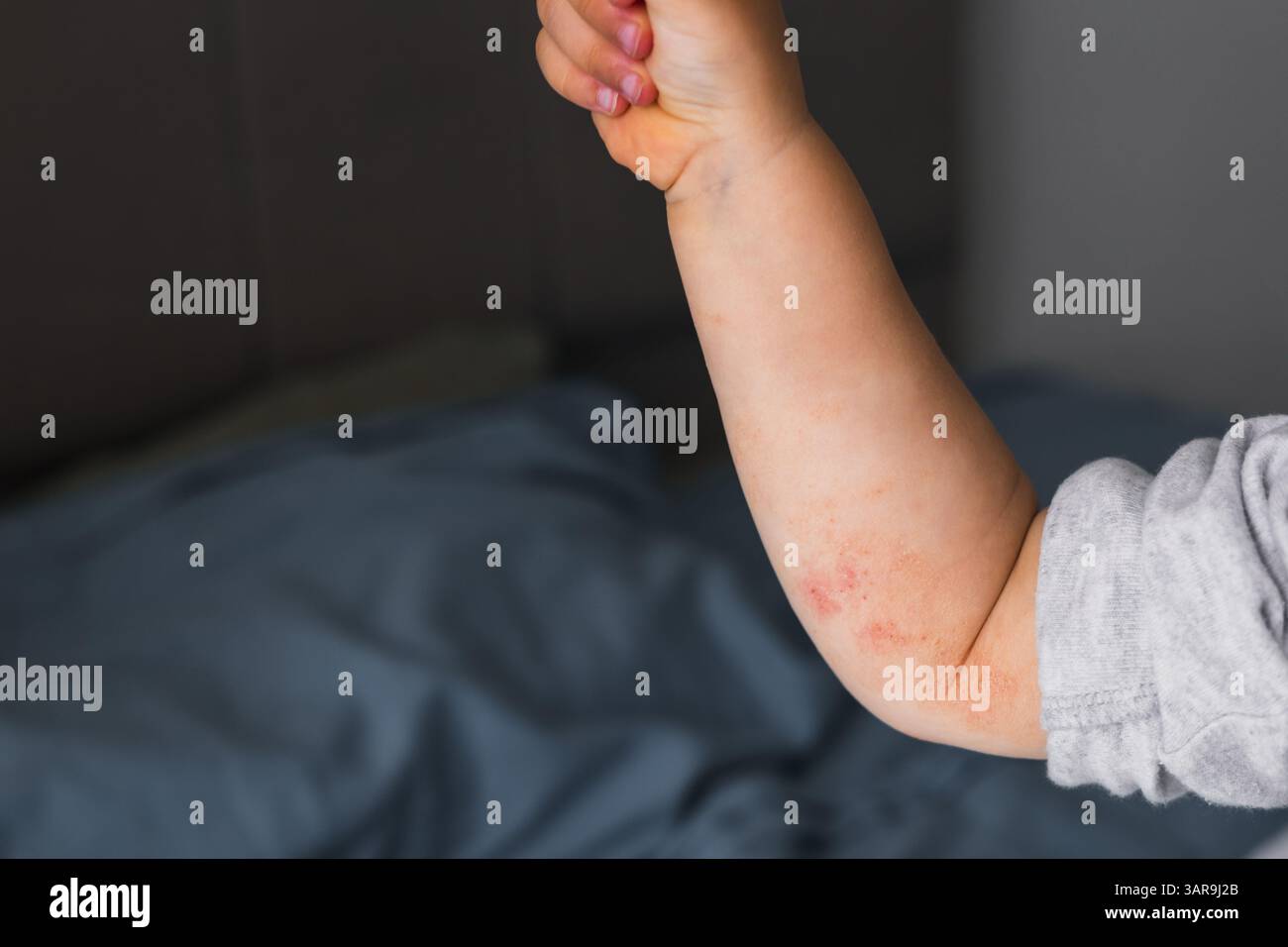 small hand of child covered by eczema. allergy baby skin dermatitis food. Unrecognizable ...