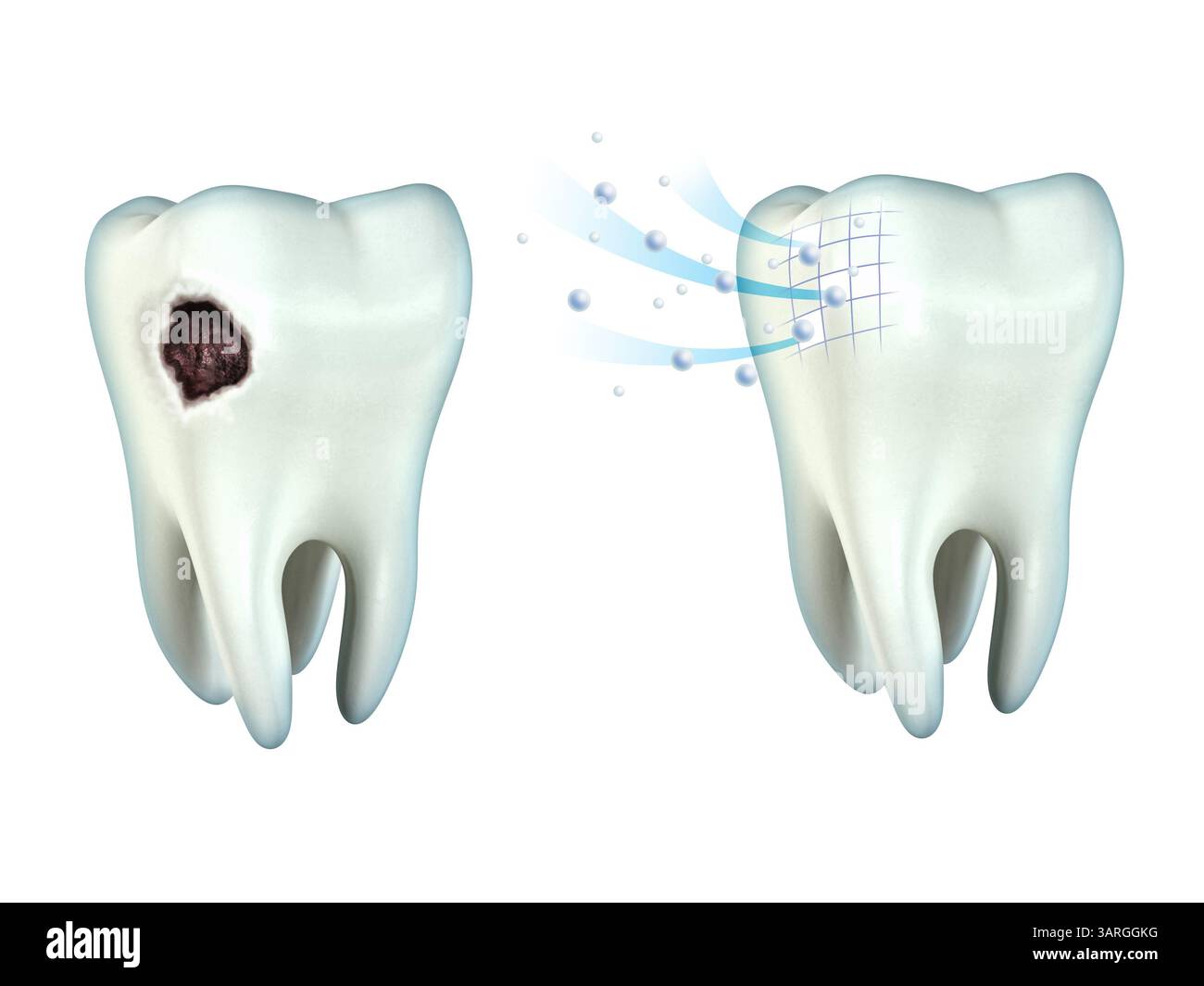 Tooth cavity and tooth remineralization. Digital illustration, clipping ...