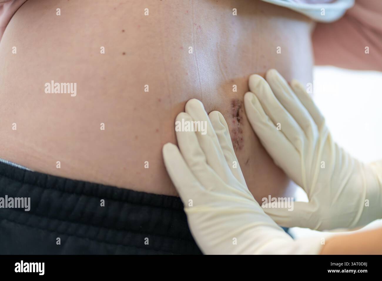 Healthcare worker in gloves closely inspects healing incision on ...