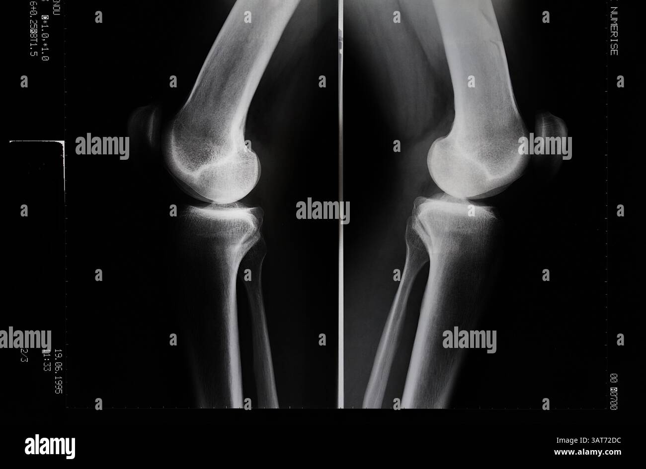 Medical X-Ray Of The Side Of A Pair Of Knee Joints And Legs Showing ...