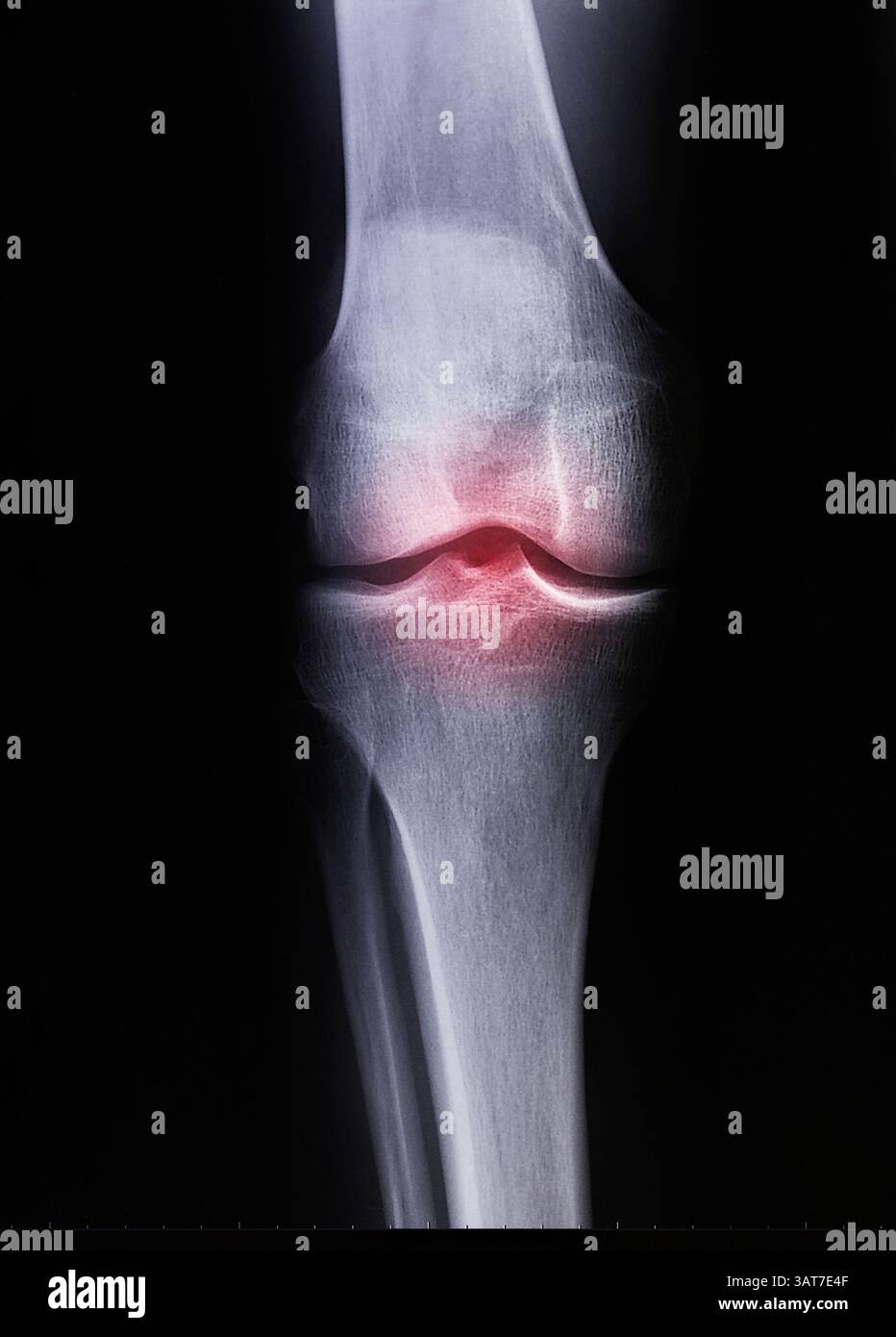 Medical X-Ray Of The Back Of A Knee Joint And Leg Overlay Of Pain Area ...