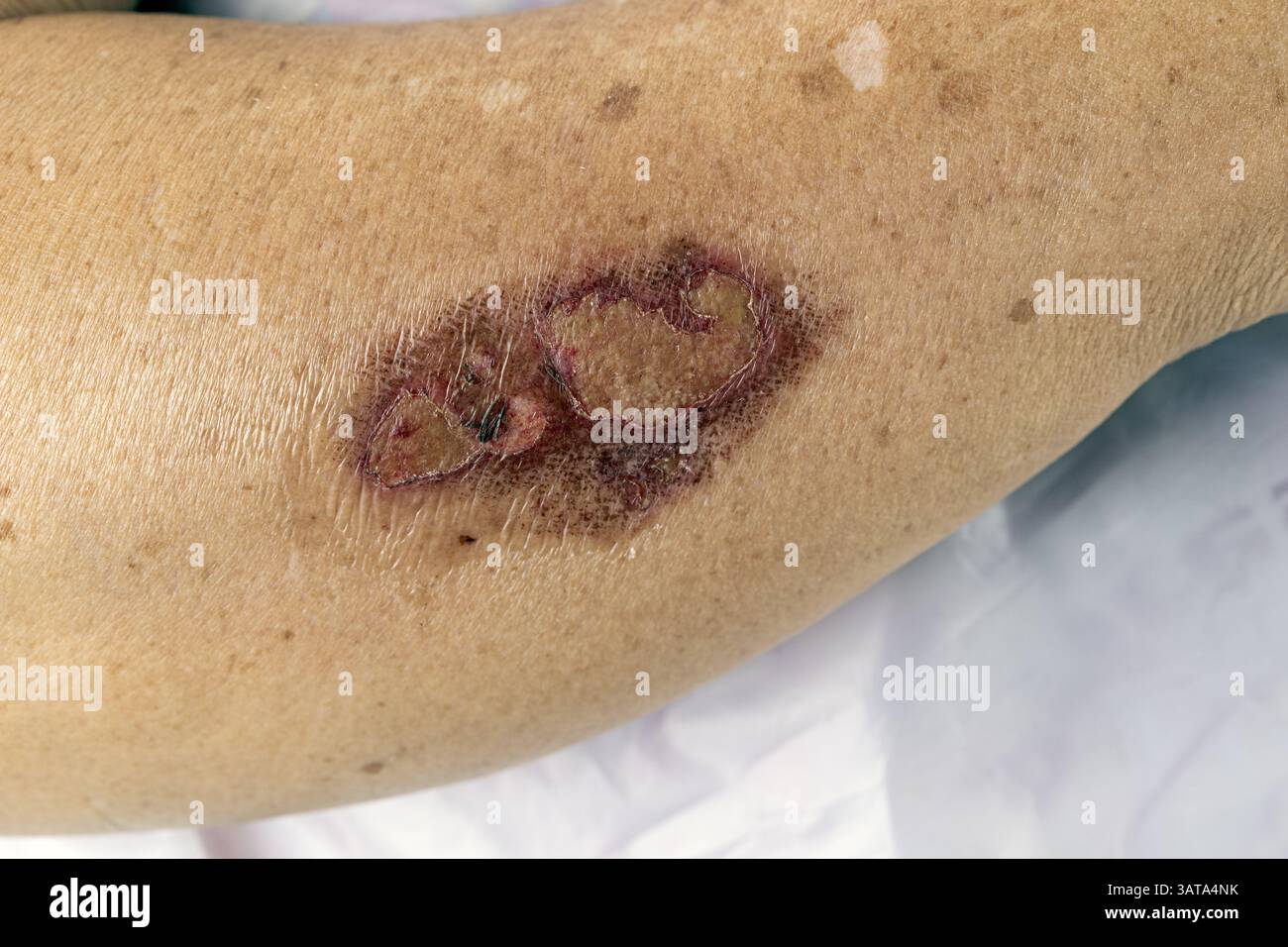 Scalds on the Skin: A medical image showing a scald on the skin of the ...