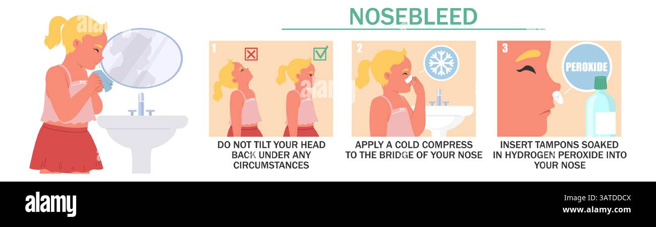 Understanding how to treat a nosebleed is crucial for effective relief ...