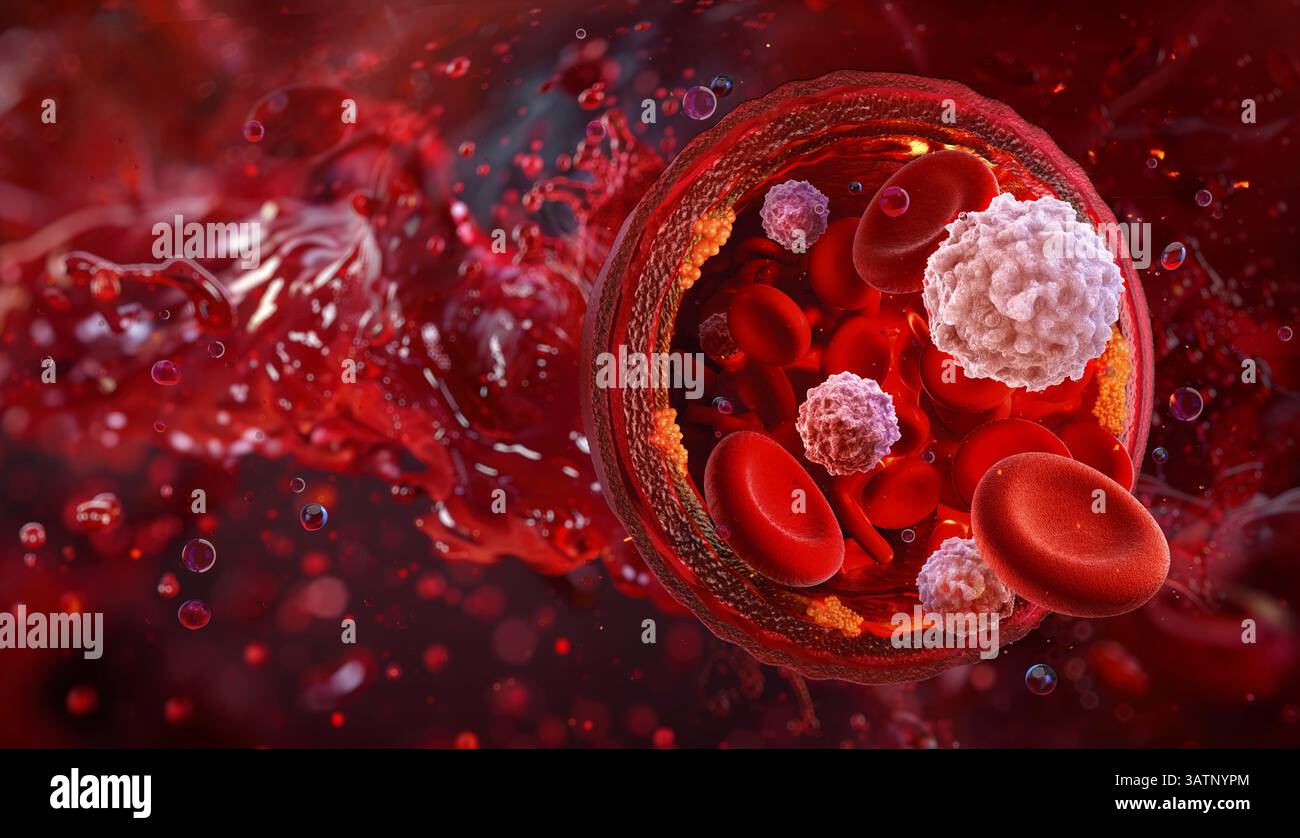 Illustration of elevated white blood cell count (leucocytosis) as part ...