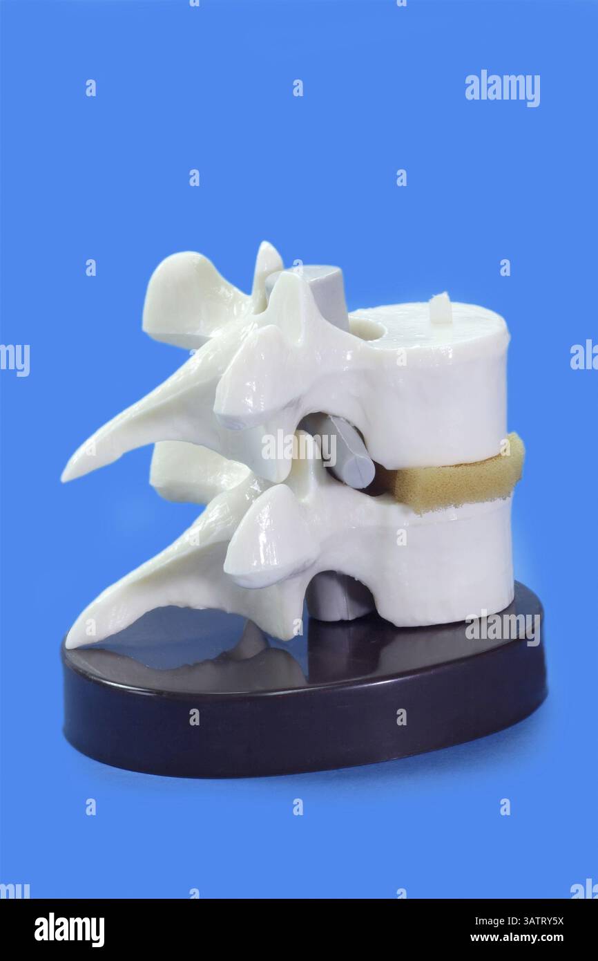 Teaching model of human spinal discs on blue background Human anatomic ...