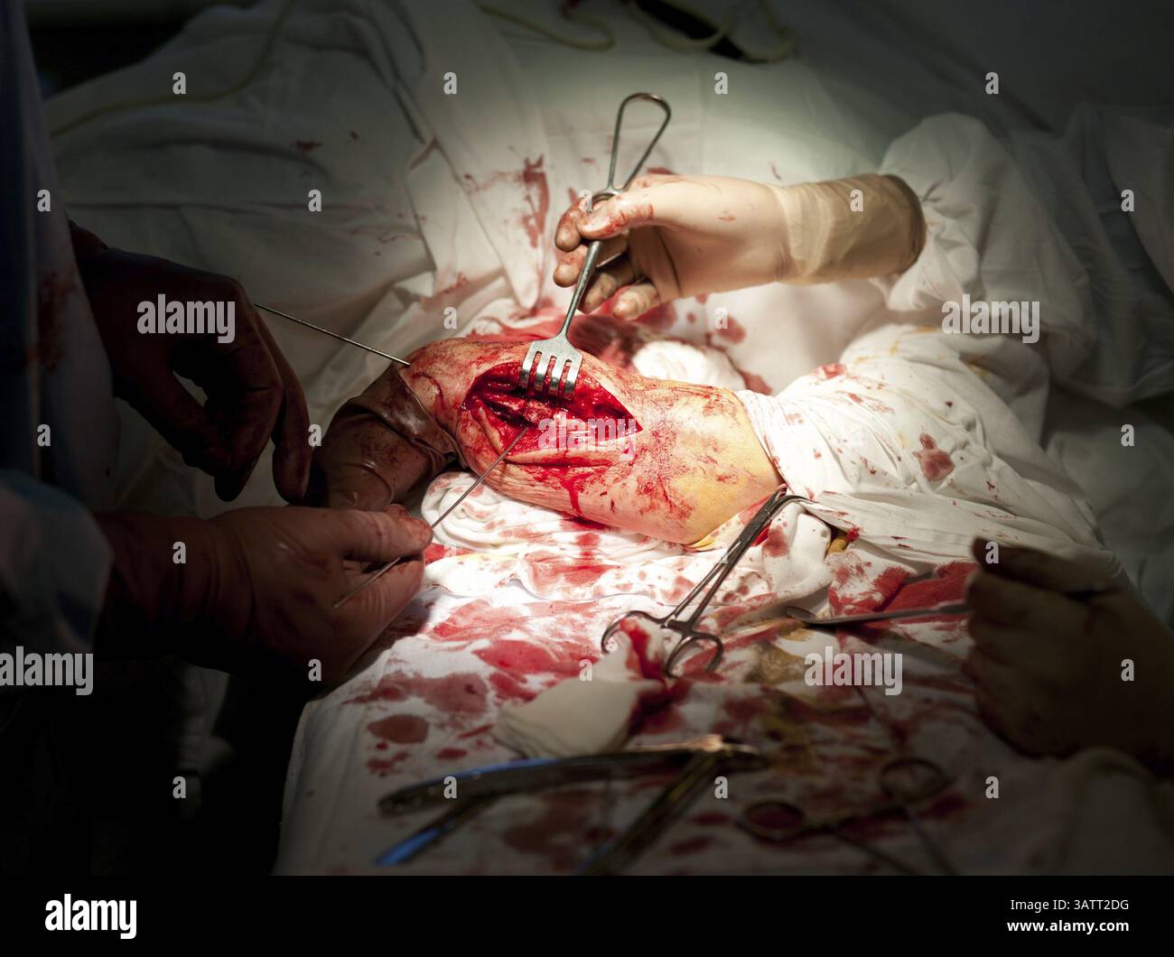 A real surgical operation on forearm bones Stock Photo - Alamy