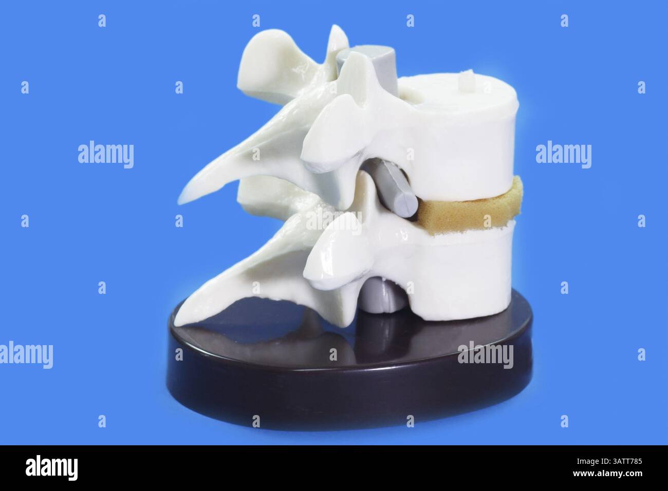 Teaching model of the human spinal disc. Human anatomy Spinal disk on ...