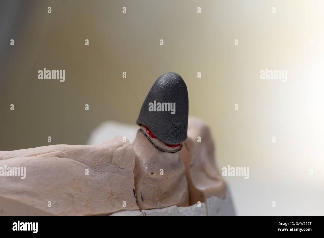 Frames of ceramic-metal crowns on the stand of the articulator. The ...