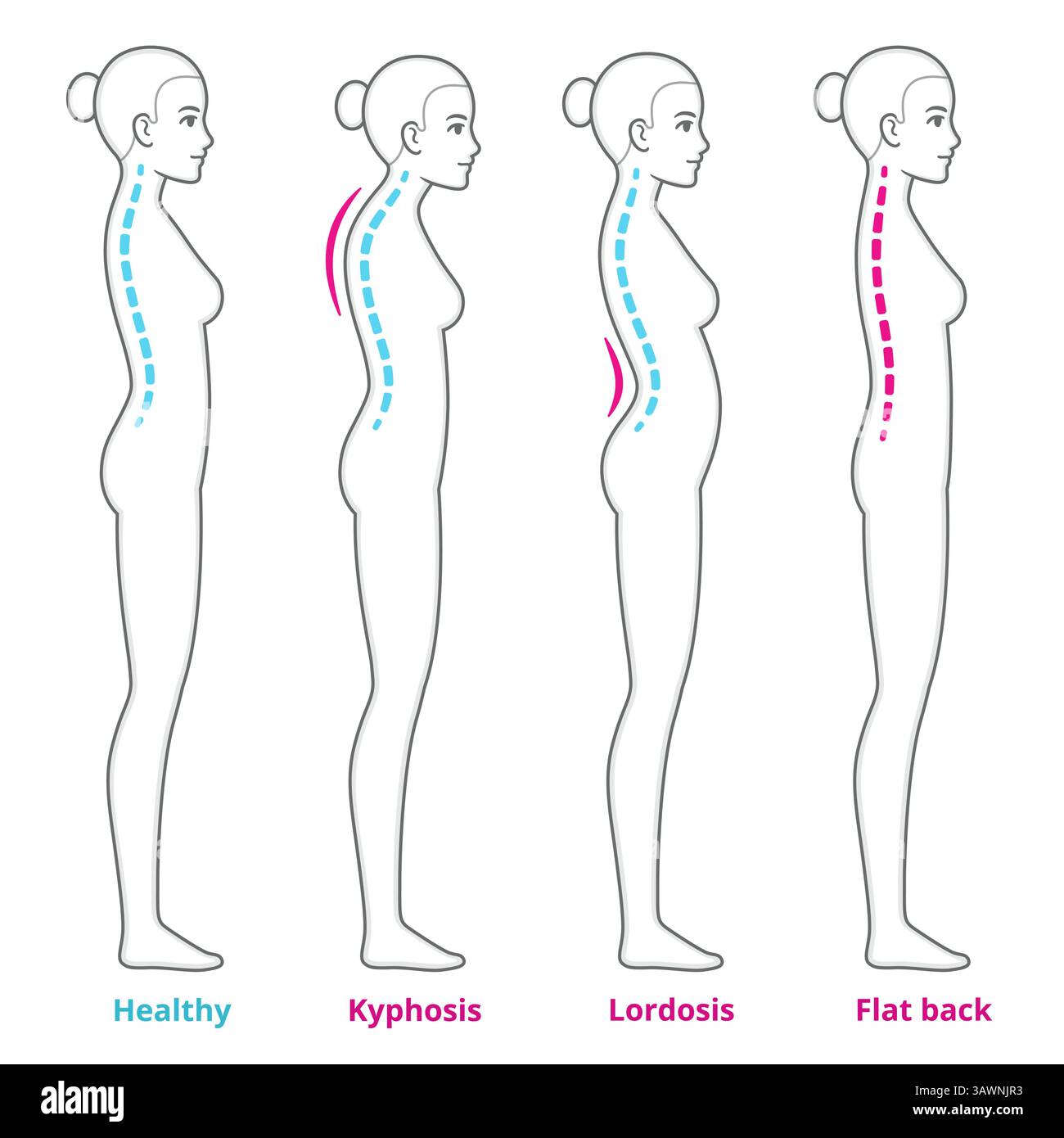 Back posture problems medical diagram. Young woman with kyphosis ...