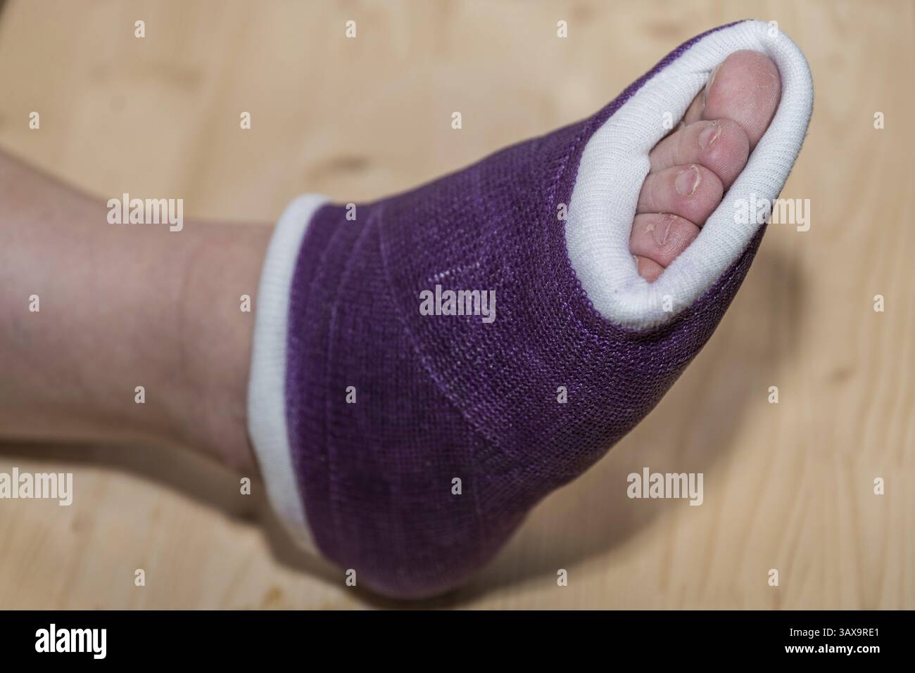 Patient with foot injury - plaster, plastic plaster Stock Photo - Alamy