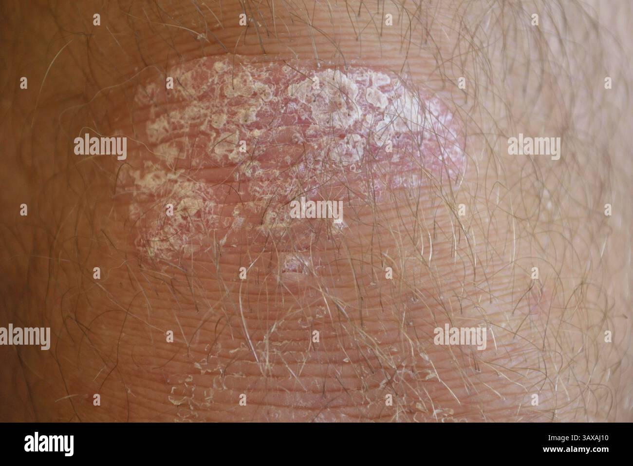 Psoriasis on the knee Stock Photo - Alamy