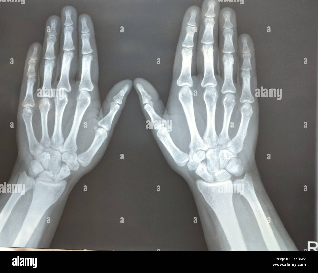 X-ray of hands Stock Photo - Alamy