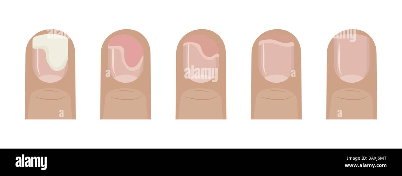 Onycholysis treatment process illustrating the gradual detachment of the nail plate from the ...