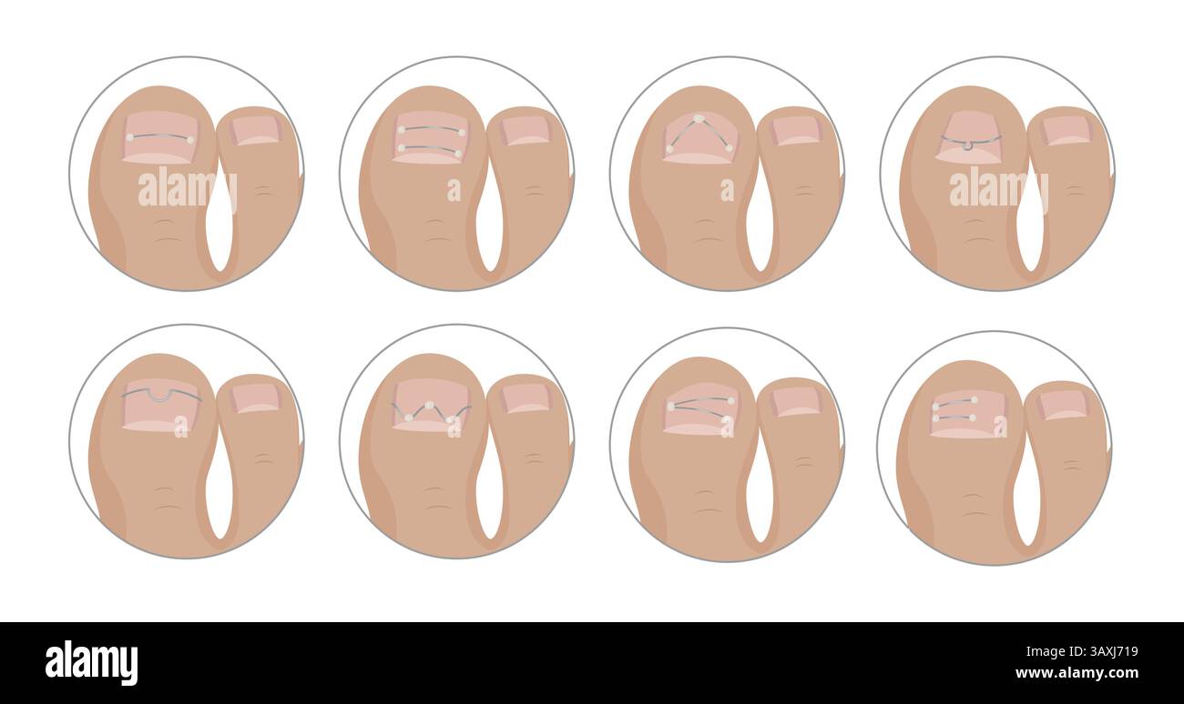Correcting toenail with titanium thread, different types of nail cure ...