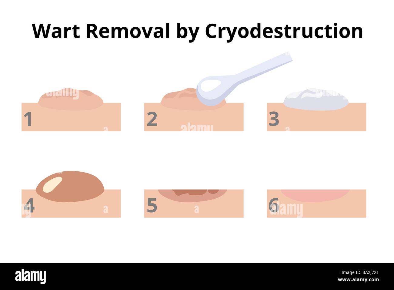 Cryodestruction procedure showing six steps of wart removal process ...