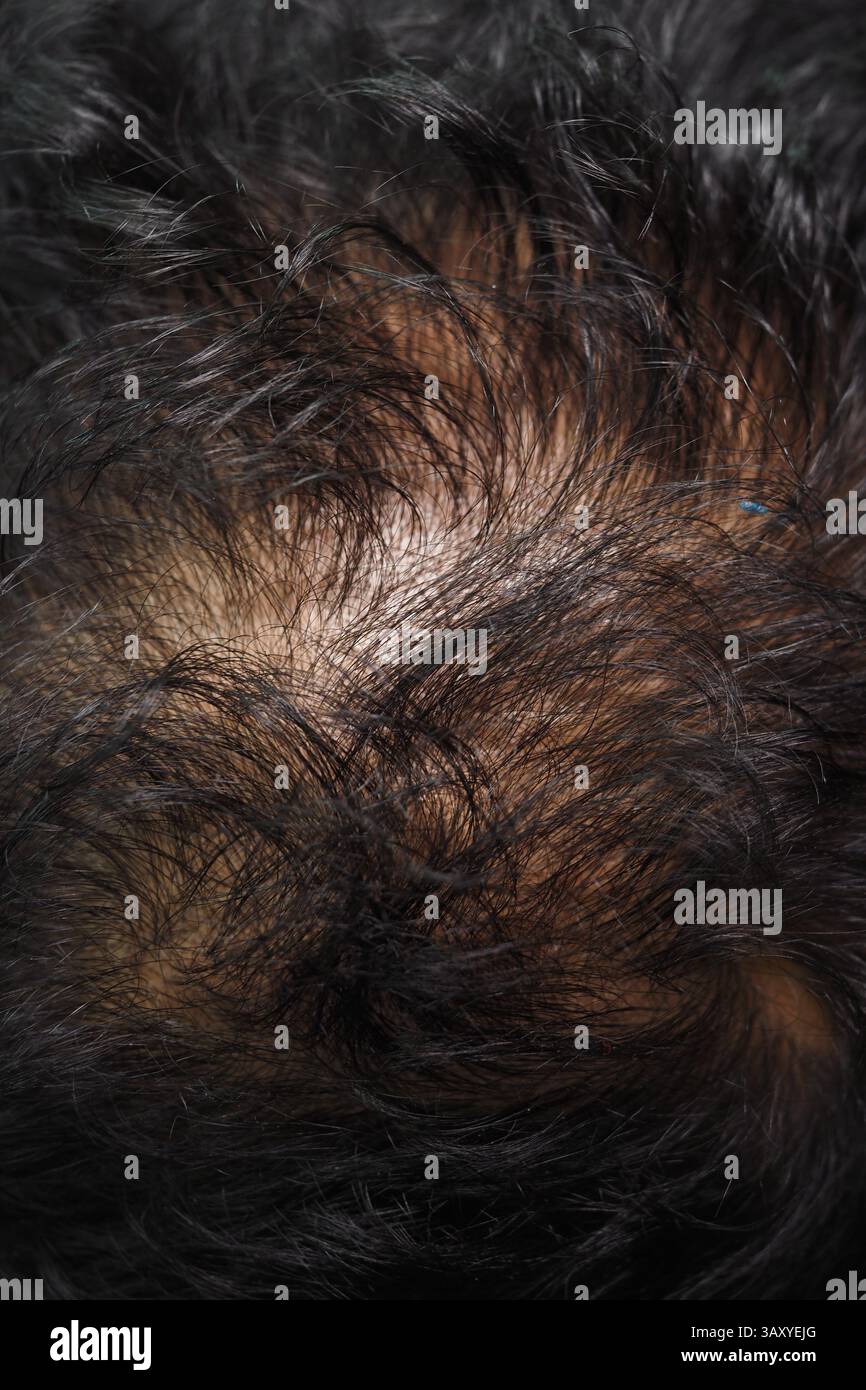 Skin hair follicles showing hi-res stock photography and images - Alamy