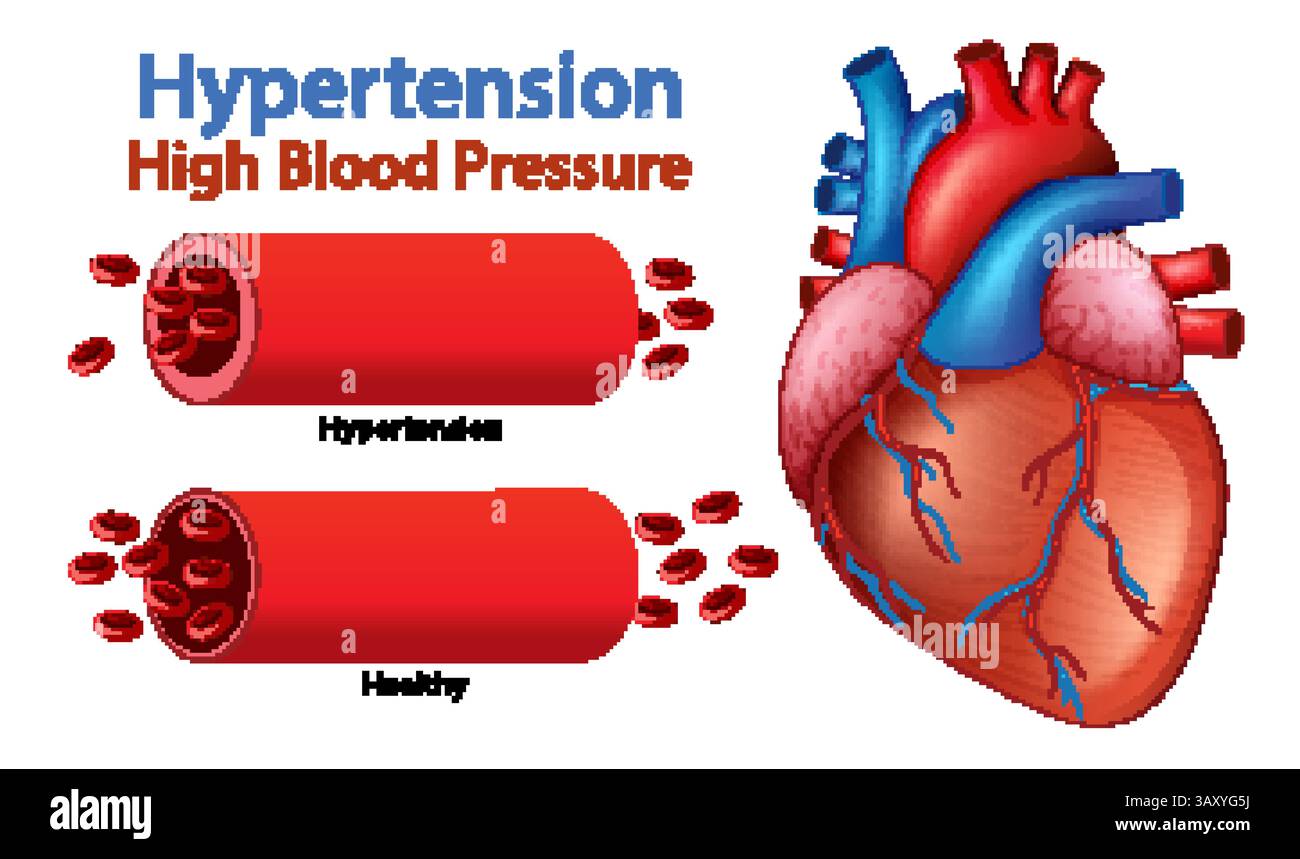 Detailed vector illustration of hypertension effects on blood vessels ...