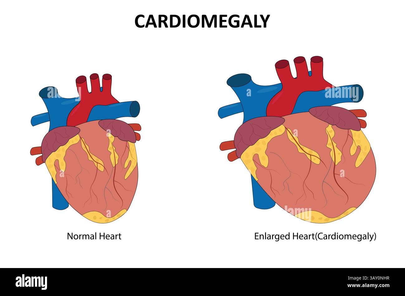 Cardiomegaly, enlarged heart vector illustration Stock Vector Image ...